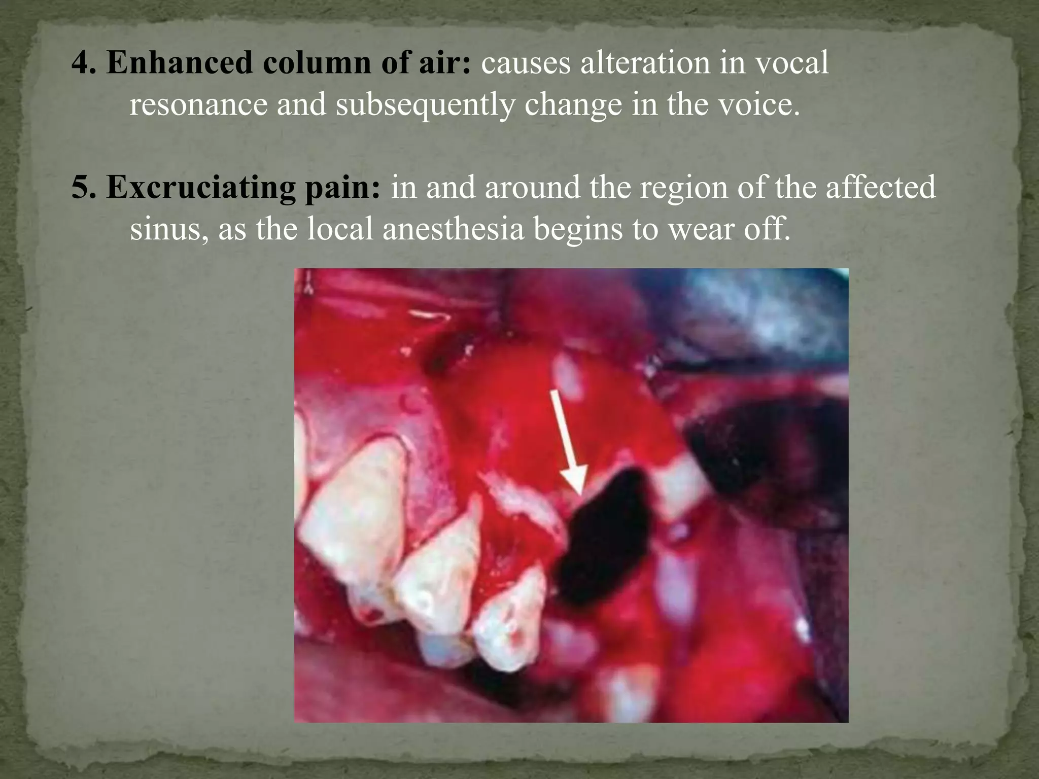 Oroantral Fistula | PPTX