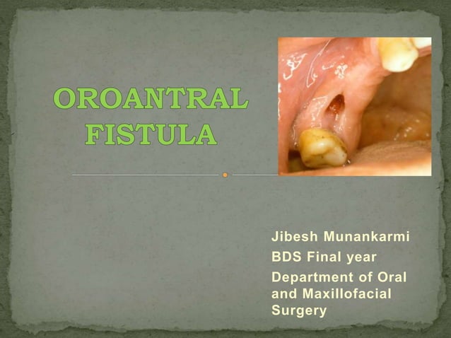 Oroantral Fistula | PPTX | Ear, Nose and Throat Conditions | Diseases ...