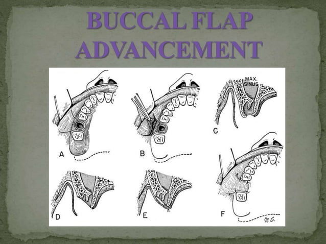 Oroantral Fistula | PPTX | Ear, Nose and Throat Conditions | Diseases ...