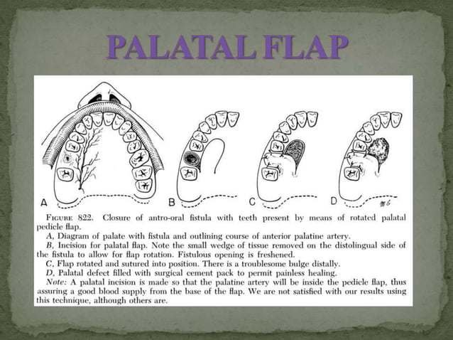Oroantral Fistula | PPTX | Ear, Nose and Throat Conditions | Diseases ...