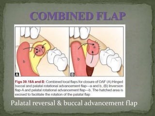 Oroantral Fistula | PPTX