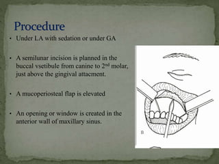 Oroantral Fistula | PPTX