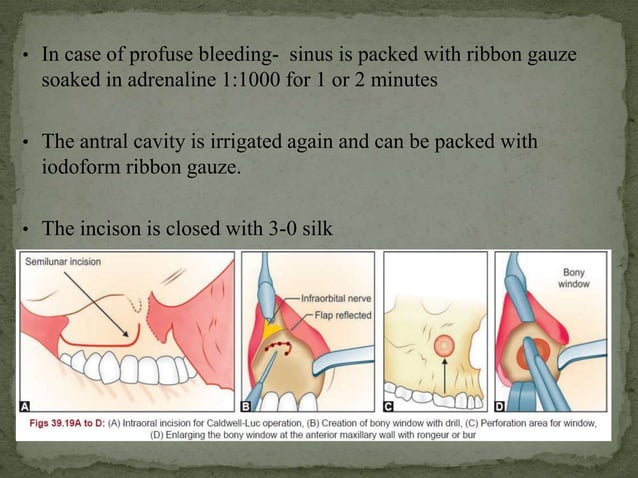 Oroantral Fistula | PPTX | Ear, Nose and Throat Conditions | Diseases ...