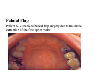 oroantral fistula mohamad.pptx