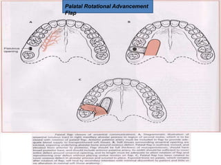 OROANTRAL FISTULA mohammad abusad.pptx