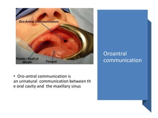 OROANTRAL FISTULA mohammad abusad.pptx