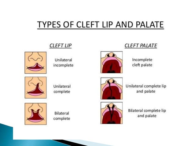 Orofacial clefts | PPTX