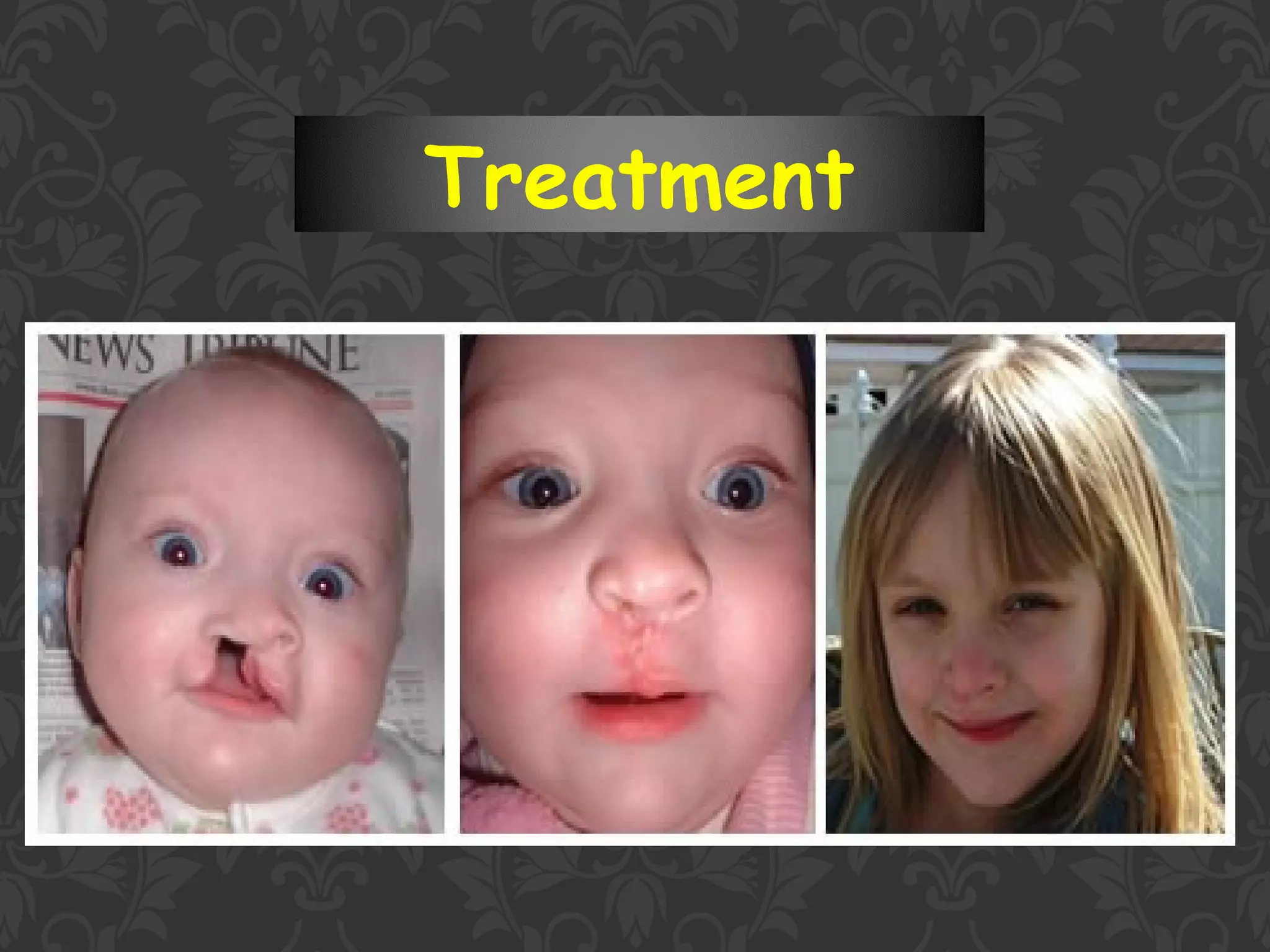 Orofacial clefts | PPT