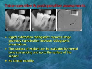 Orofacial implant | PPT