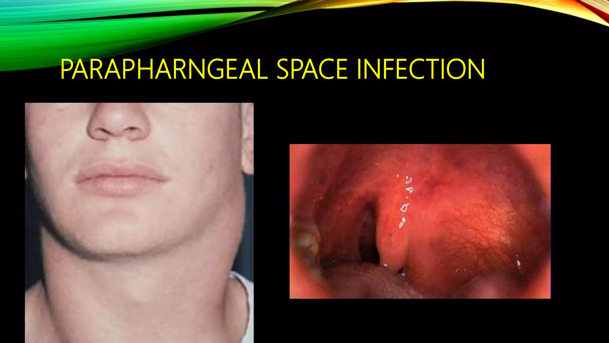 Orofacial infection part 1 | PPTX
