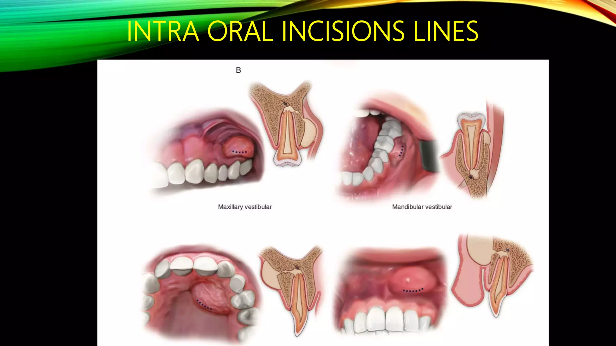 Orofacial infection part 1 | PPTX