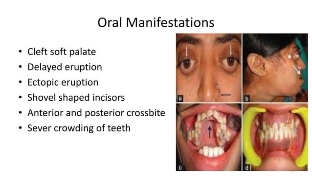 Orofacial Syndromes pathology ver2.pptx