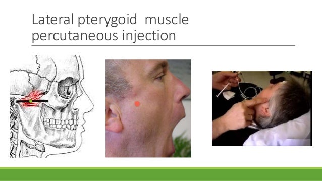 Oromandiular dystonia and spasmodic dysphonia