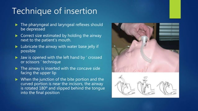 Oropharyngeal airway and nasopharyngeal airway_114337 (1).pptx | Ear ...