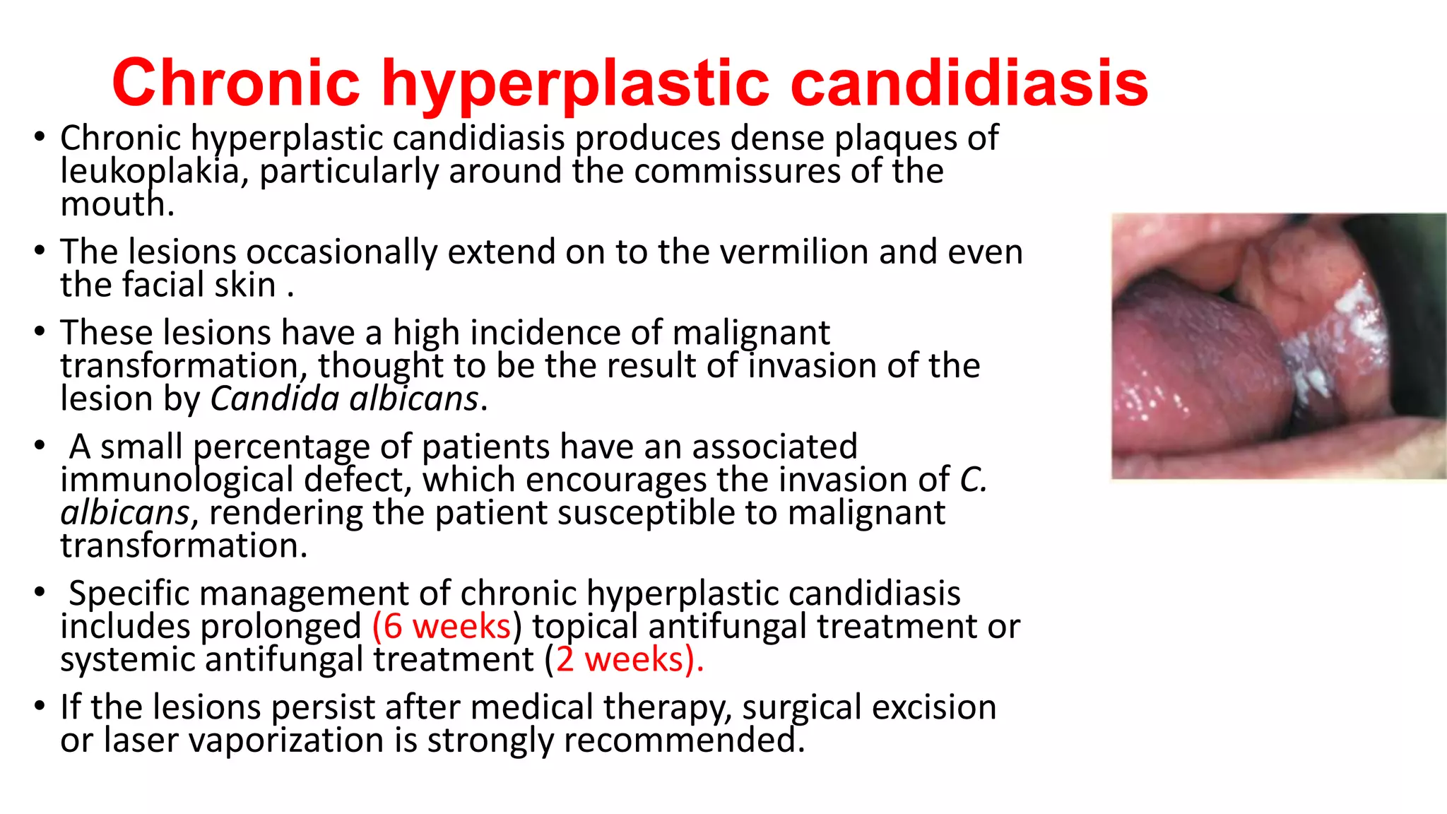 Oropharyngeal cancer | PPTX