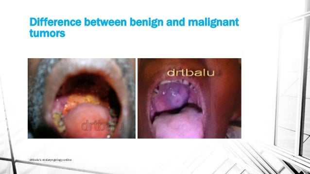 Oropharyngeal tumorsslideshare