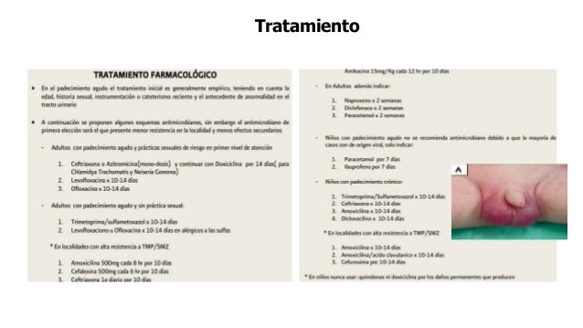 Orquitis y Epididimitis