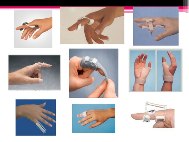 Tipos De Ortesis De Miembro Superior Ppt