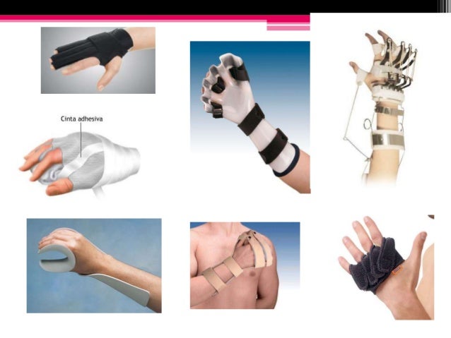 Tipos De Ortesis De Miembro Superior