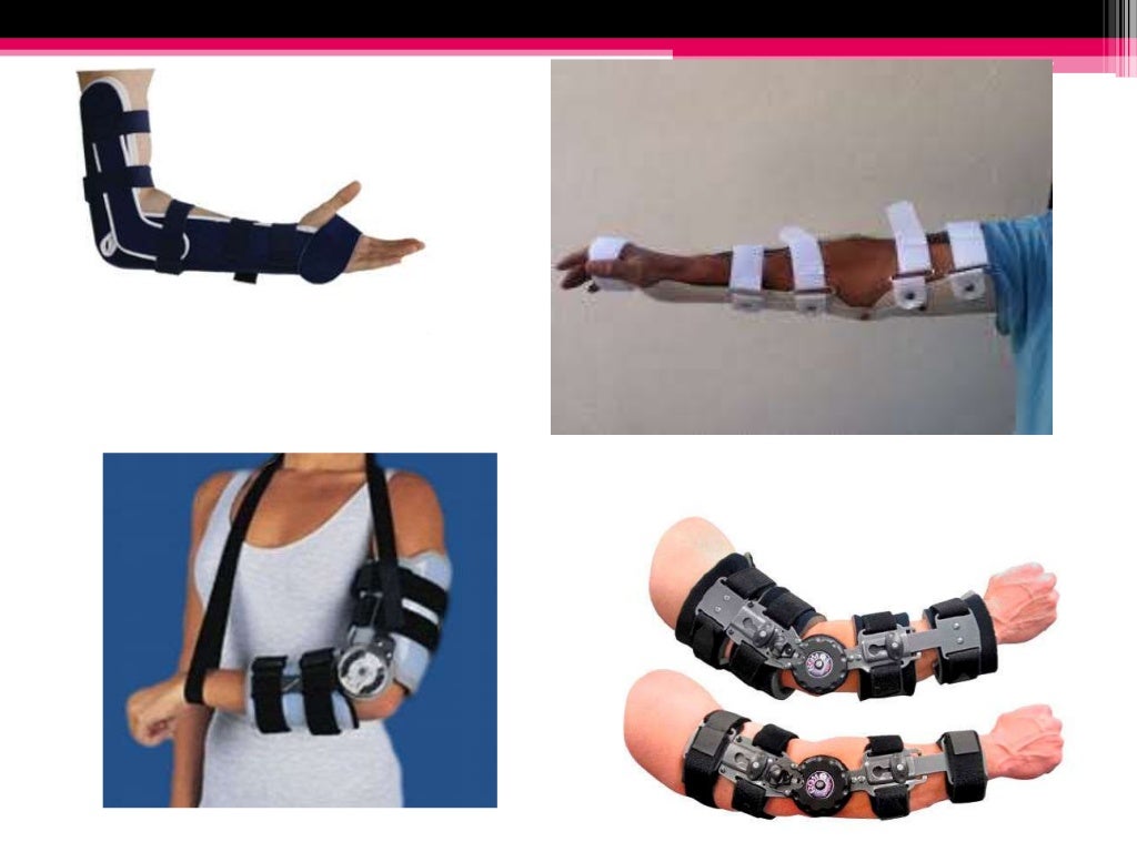 Tipos De Ortesis De Miembro Superior