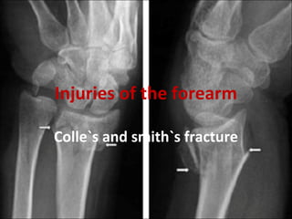 Colle`s and smith`s fracture | PPT