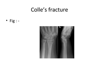Colle`s and smith`s fracture | PPT