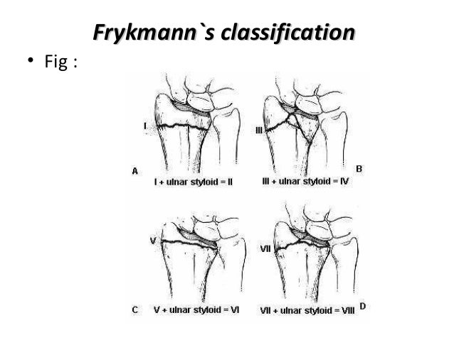 Colles Fracture Classification Wrist Fractures: What The Clinician