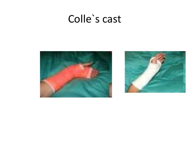 Colle`s and smith`s fracture