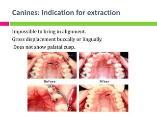 Extraction in Orthodontic Treatment | PPTX
