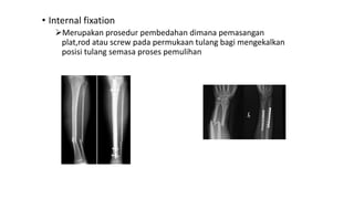 Ortho- Open fracture | PPTX