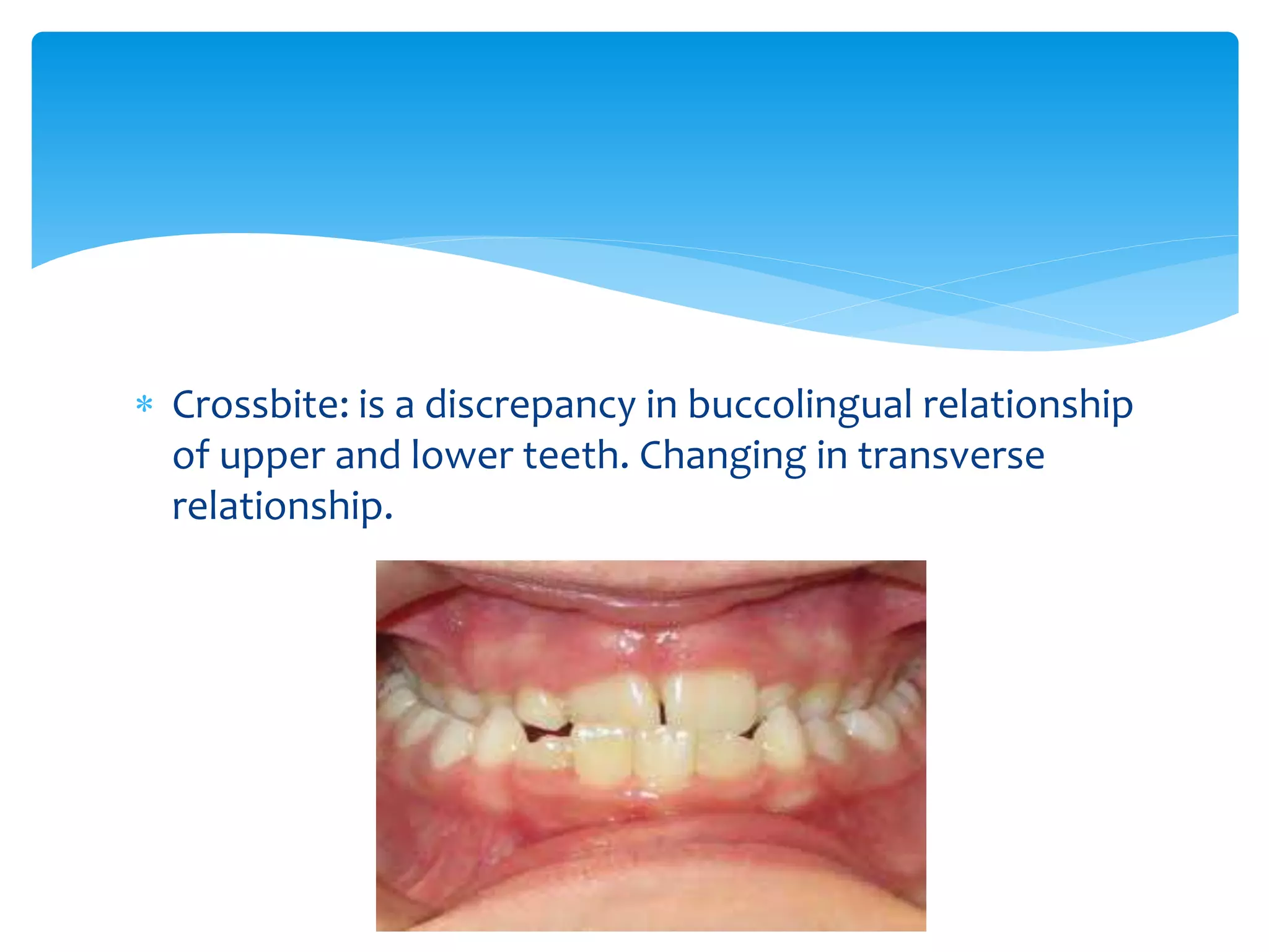 cross bite orthodontic | PPTX