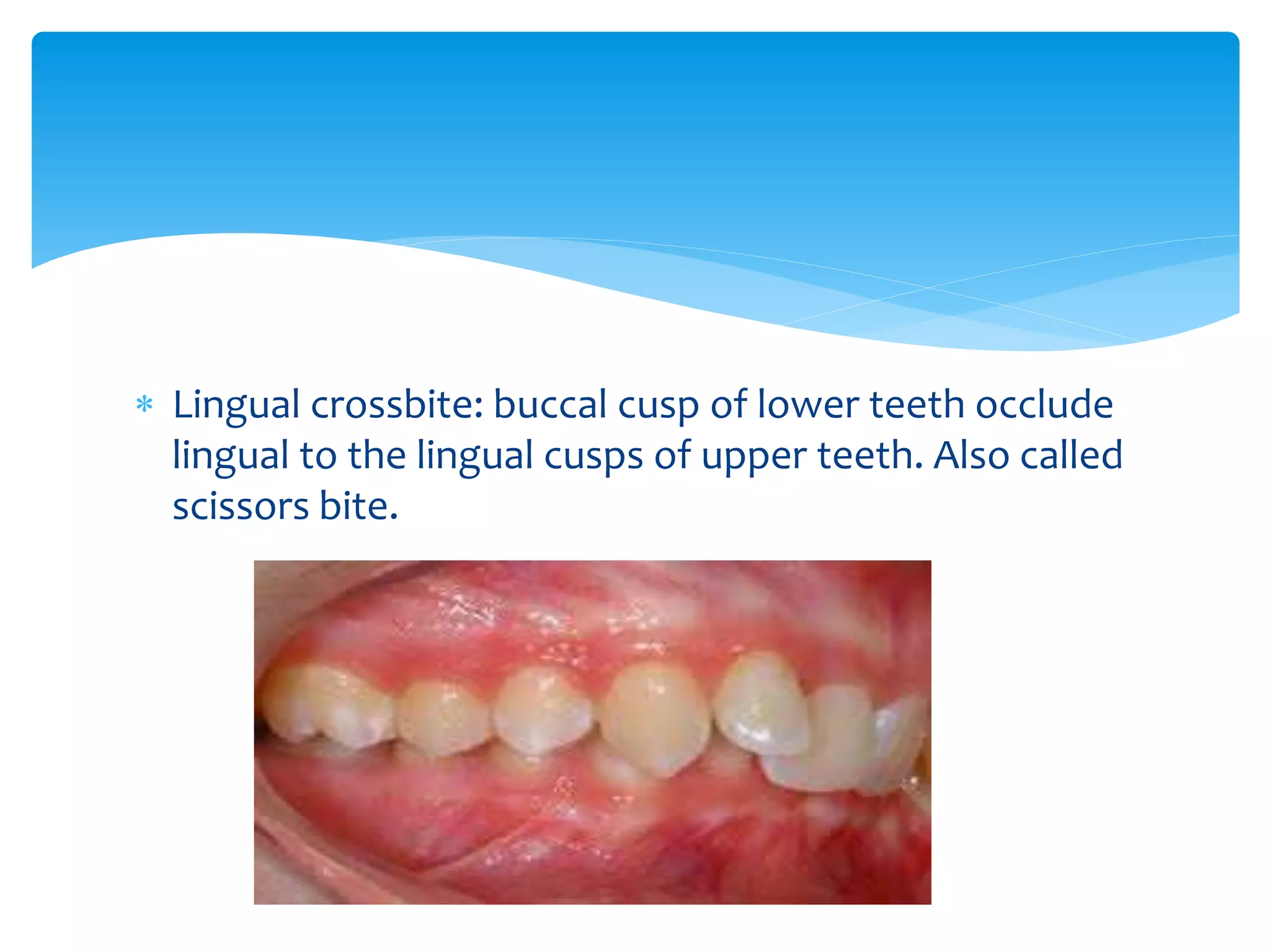 cross bite orthodontic | PPTX