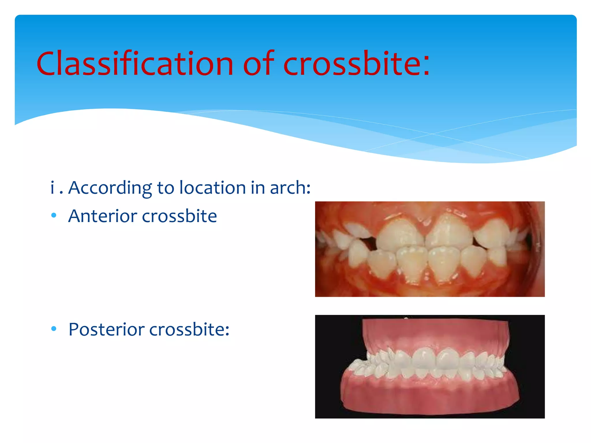 cross bite orthodontic | PPTX