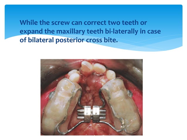cross bite orthodontic | PPTX