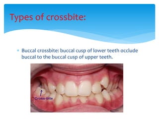 cross bite orthodontic | PPTX