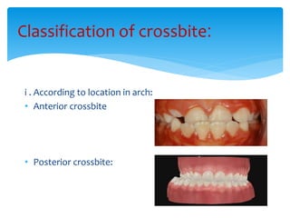 cross bite orthodontic | PPTX