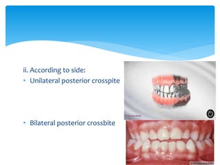 cross bite orthodontic | PPTX