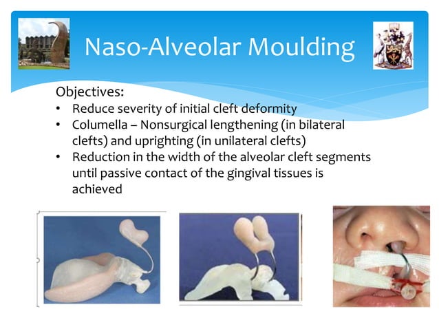 principles of Orthodontic management of cleft lip and palate | PPT ...