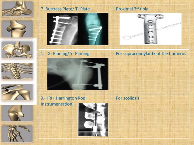 Ortho Hardware | PPT