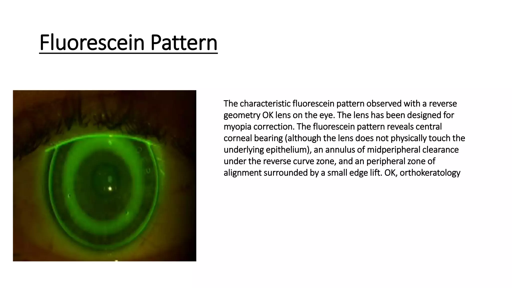 Orthokeratology | PPTX