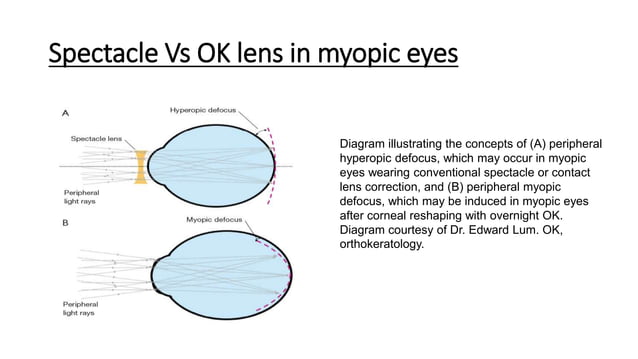 Orthokeratology | PPTX | Eye and Vision Conditions | Diseases and ...