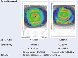 Orthokeratology_Refractive treatment | PPT