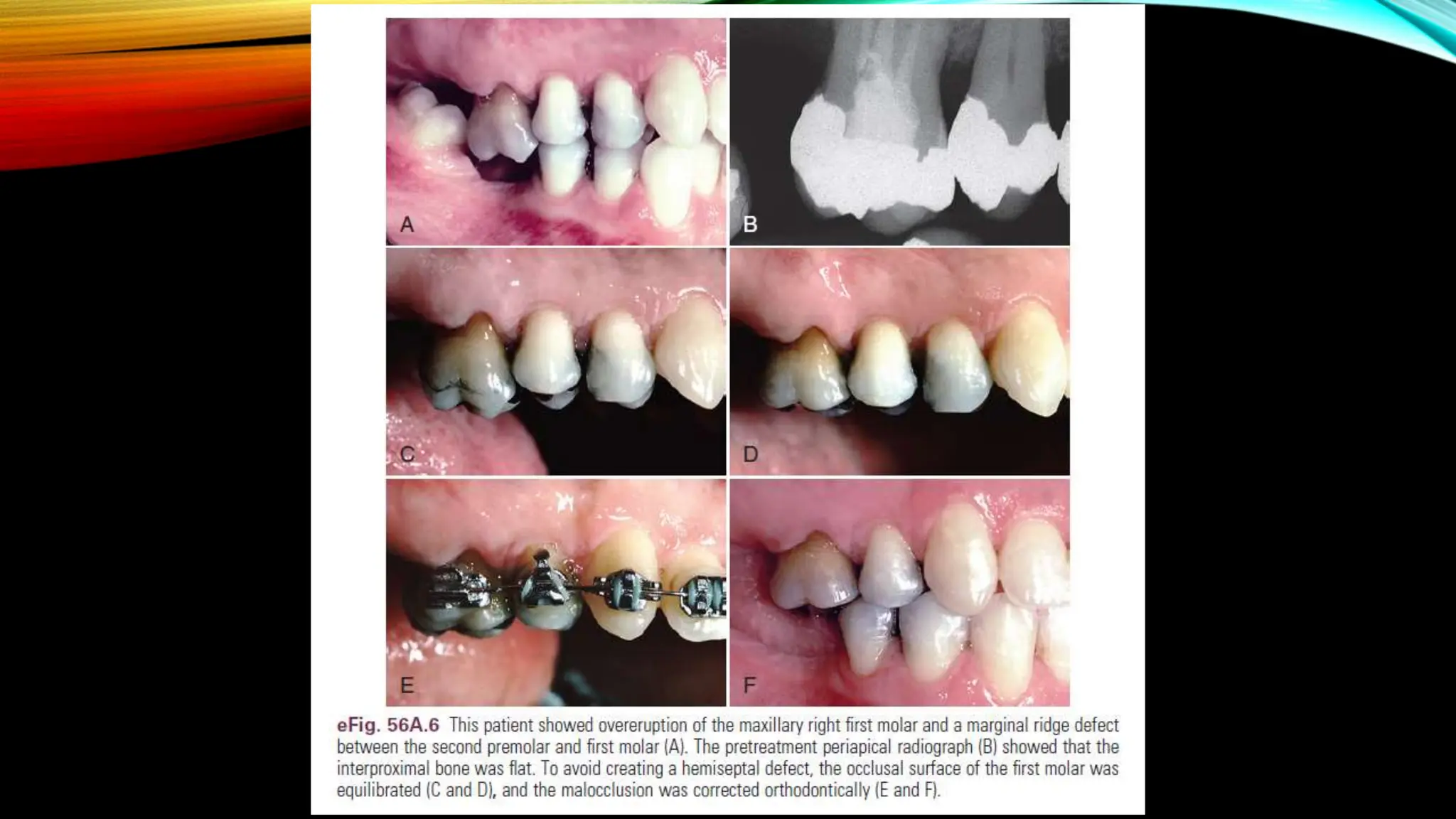 Orthodontist periodontist Ortho-perio lecture .pptx