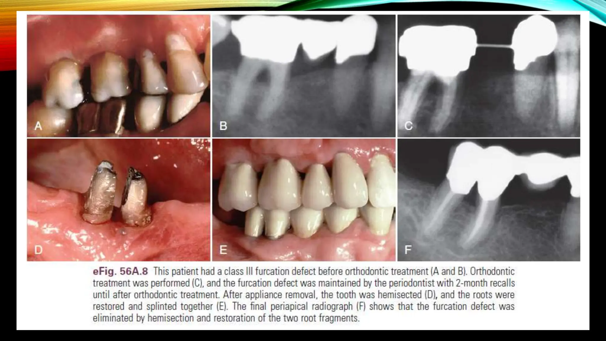 Orthodontist periodontist Ortho-perio lecture .pptx
