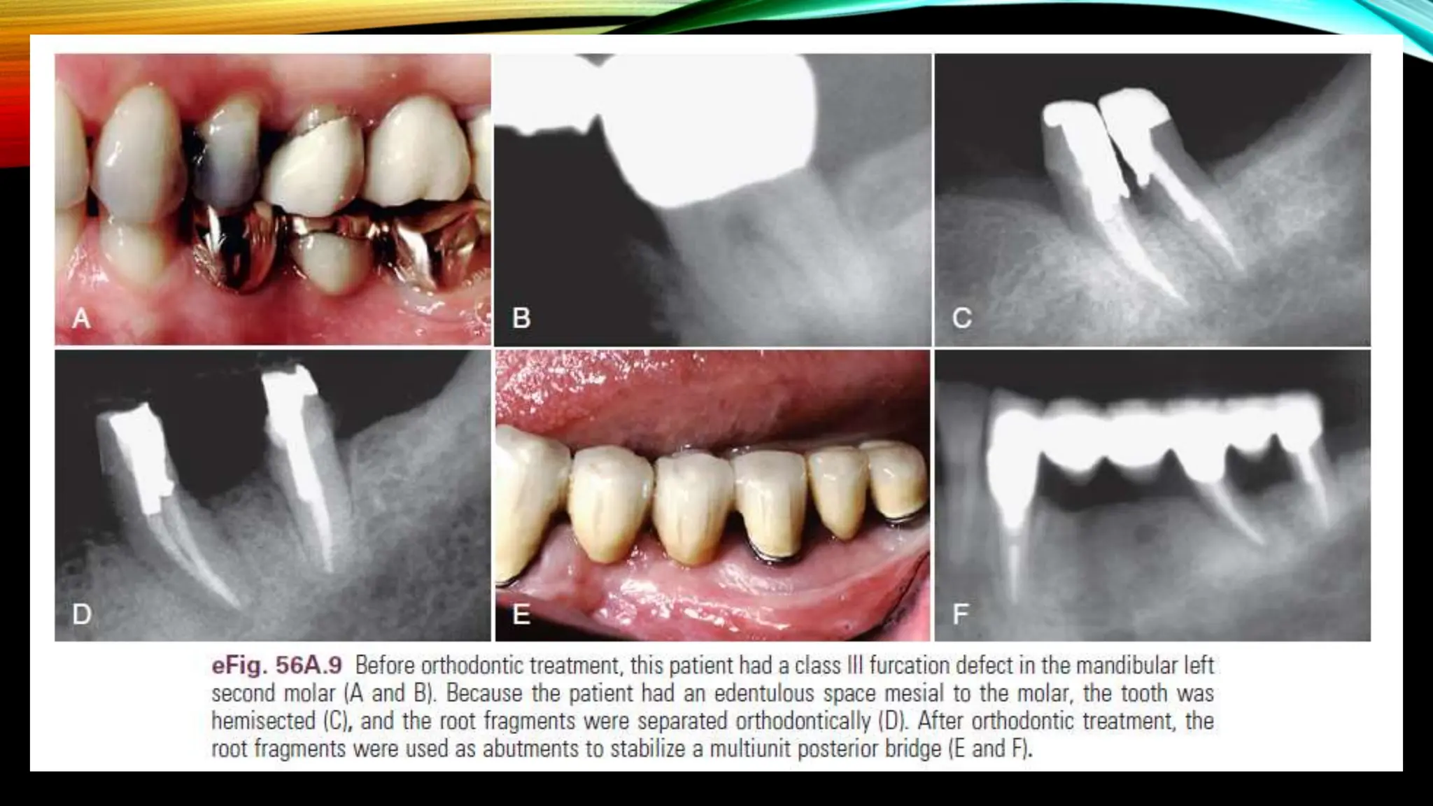 Orthodontist periodontist Ortho-perio lecture .pptx