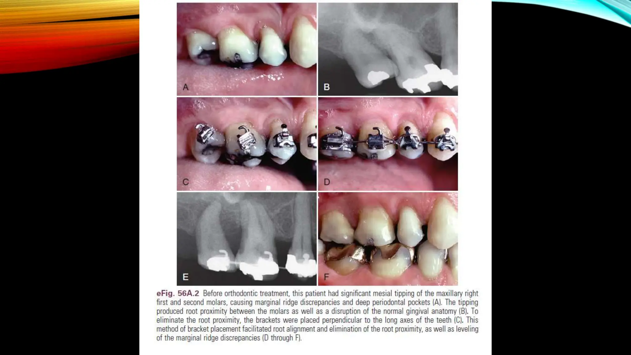 Orthodontist periodontist Ortho-perio lecture .pptx