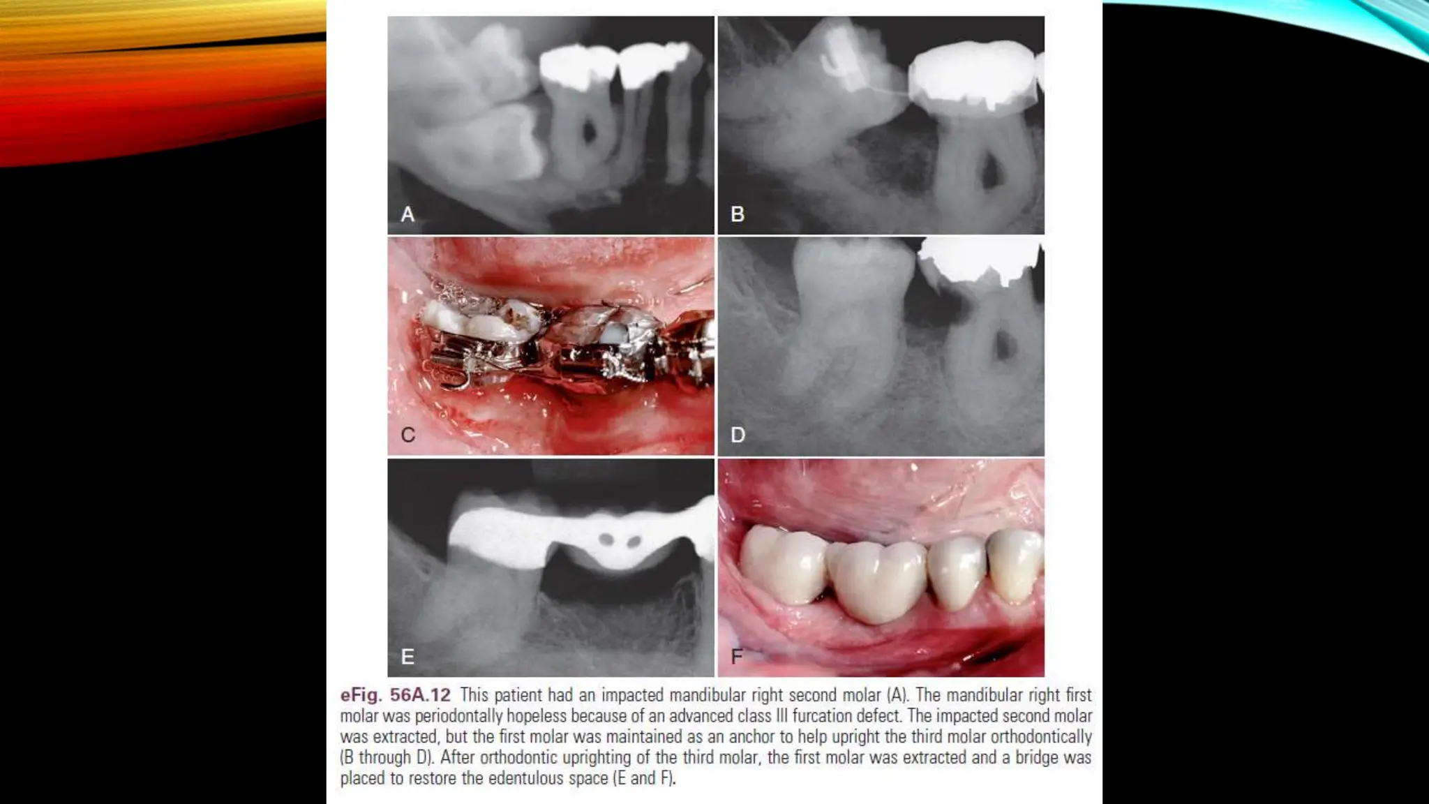 Orthodontist periodontist Ortho-perio lecture .pptx