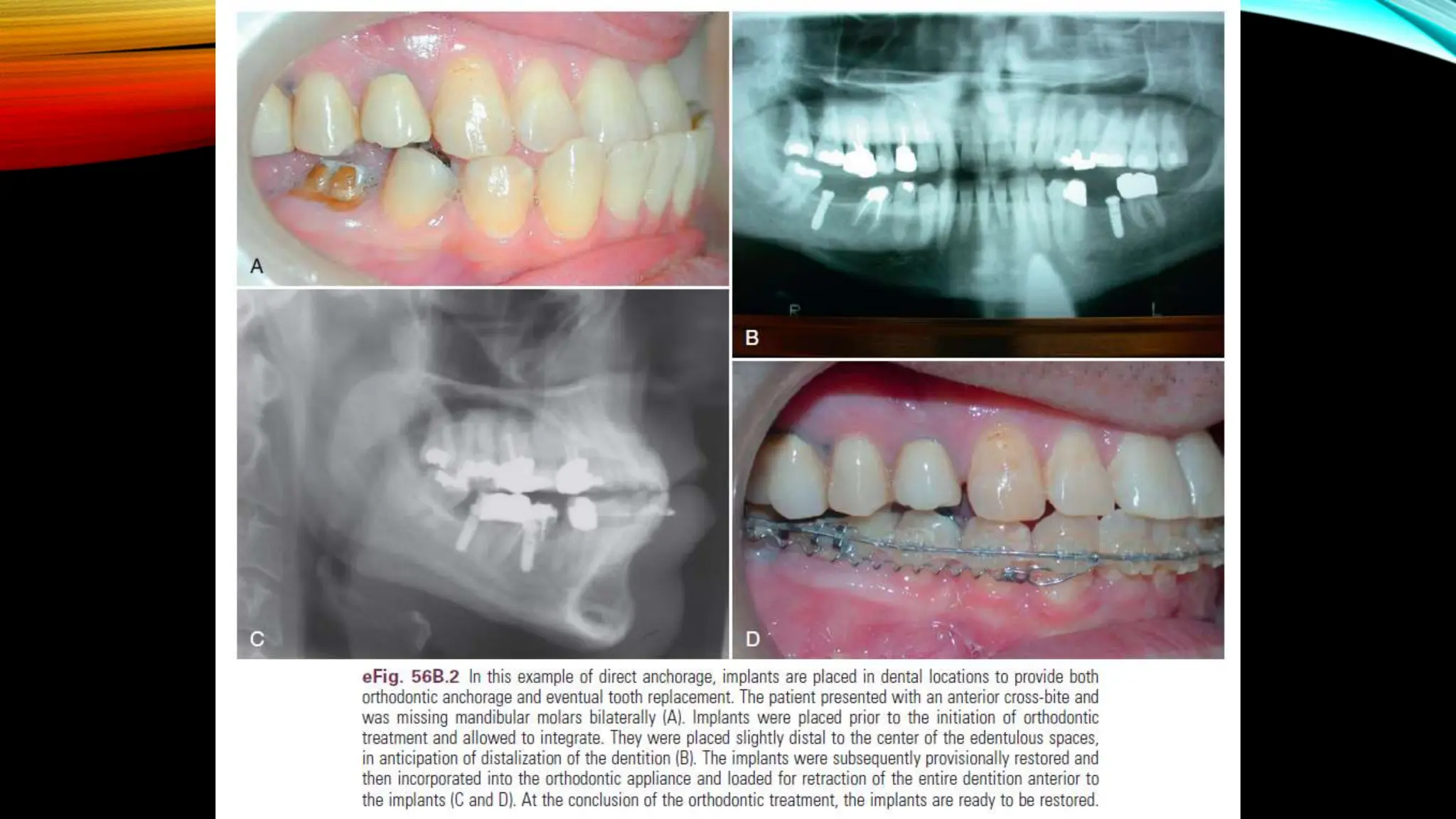 Orthodontist periodontist Ortho-perio lecture .pptx