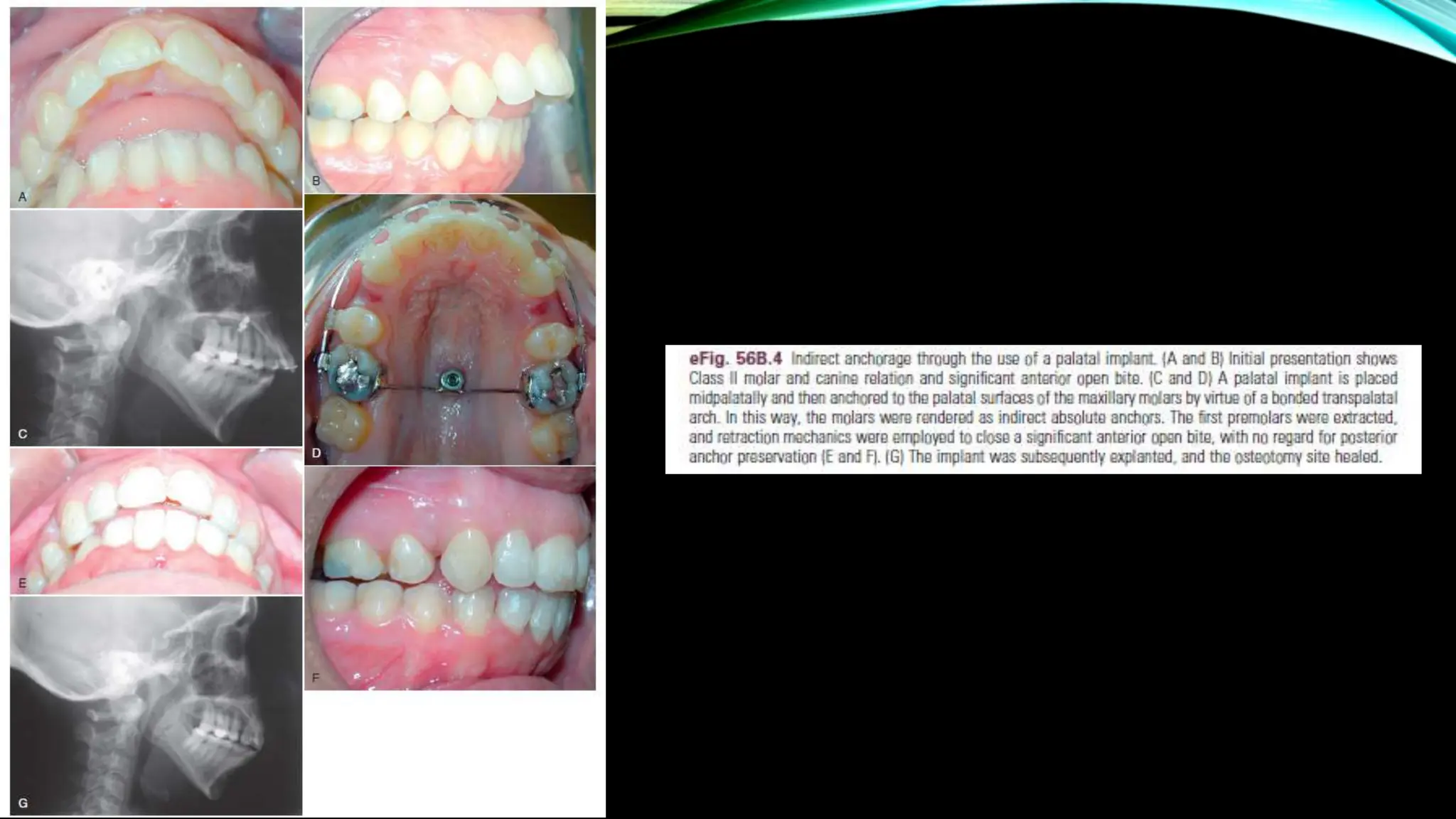 Orthodontist periodontist Ortho-perio lecture .pptx
