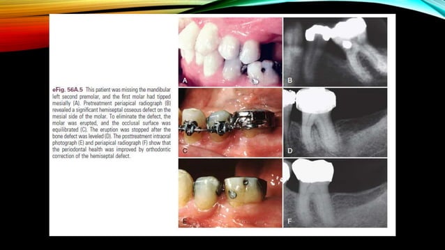 Orthodontist periodontist Ortho-perio lecture .pptx
